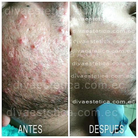Limpieza Facial Profunda - Diva Estetica Guayaquil